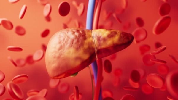 Has the problem of fatty liver increased even without consuming alcohol ...